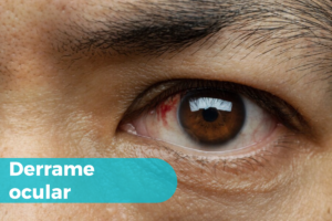 Derrame Ocular: causas, síntomas y tratamiento - Doctorisy