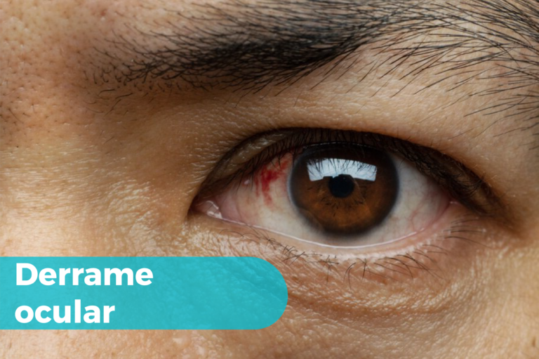Derrame Ocular: causas, síntomas y tratamiento - Doctorisy