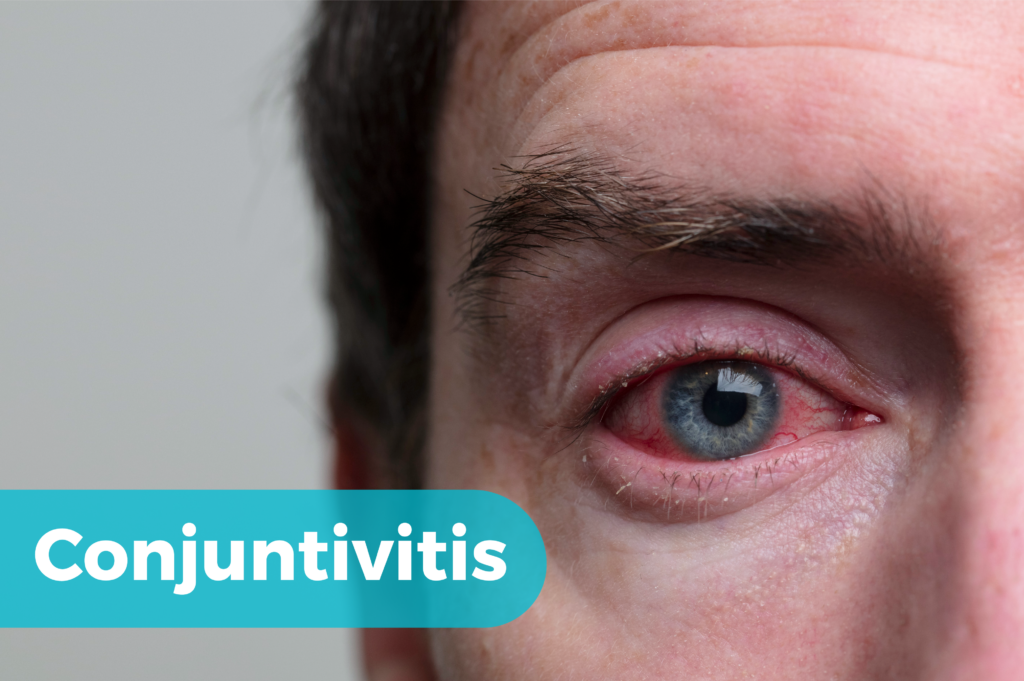 Conjuntivitis: causas, síntomas y tratamiento - Doctorisy