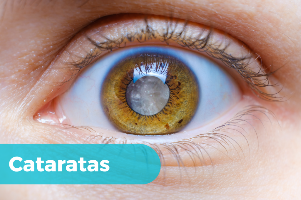 Cataratas: causas, síntomas y tratamiento - Doctorisy
