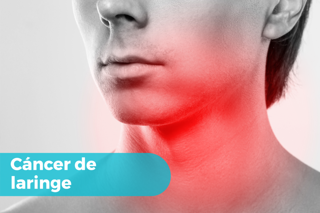 Cáncer de laringe: causas, síntomas y tratamiento - Doctorisy